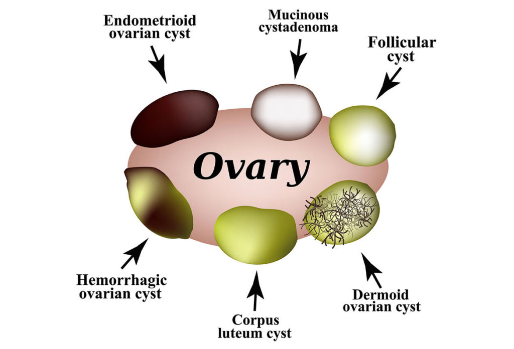 Chisturile ovariene - Dr Erna Stoian